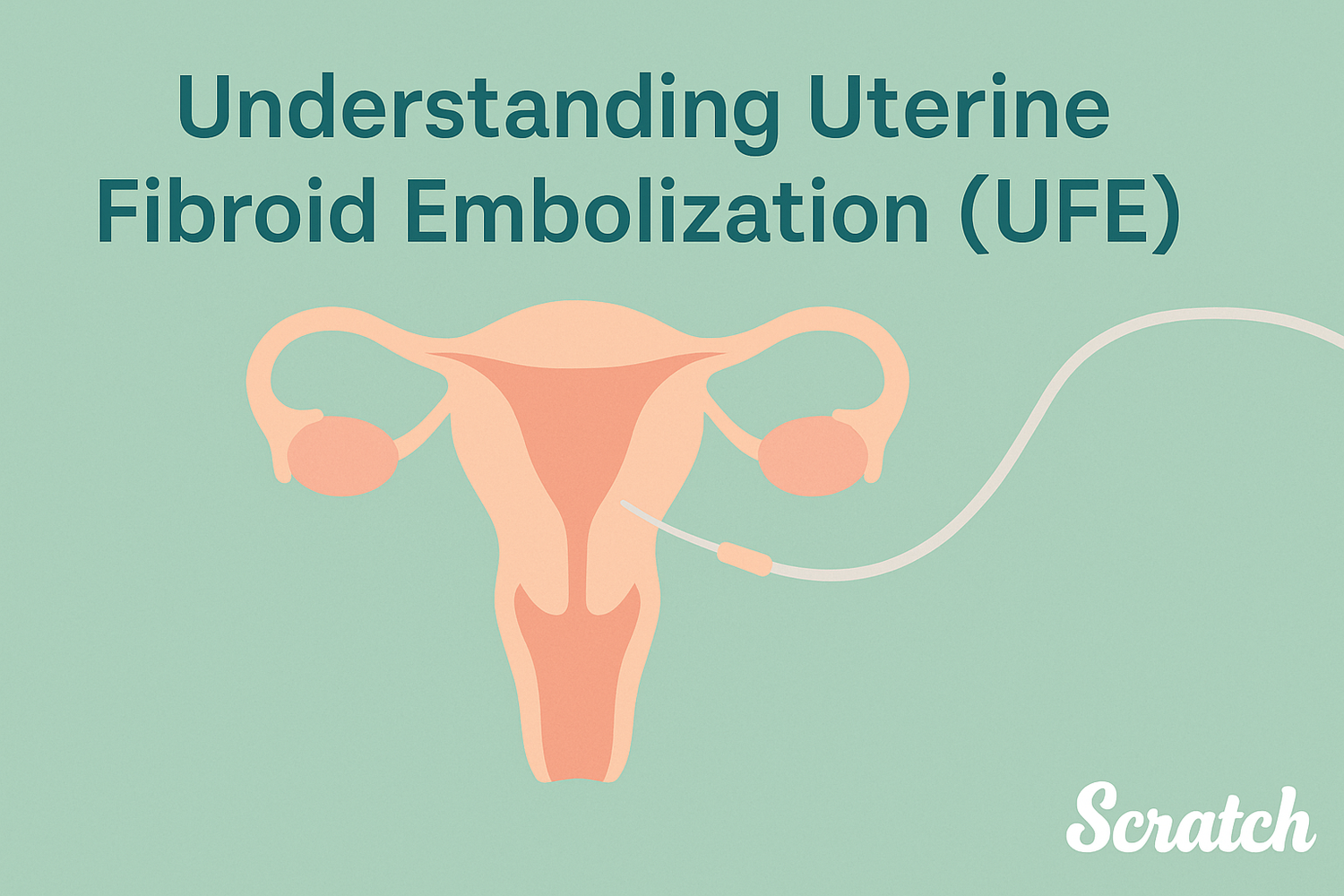Understanding Uterine Fibroid Embolization (UFE) – Scratch